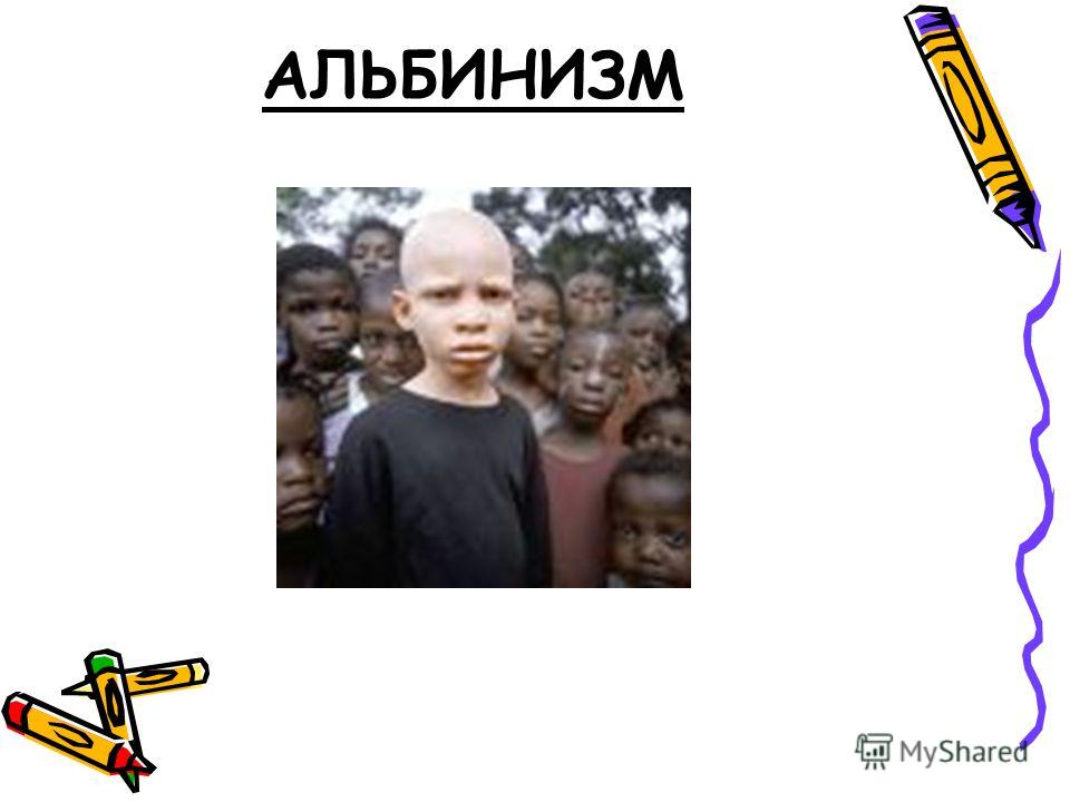 Презентация на тему АЛЬБИНИЗМ Альбинизм от латинского « Albus